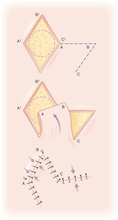 Transposition Flaps - Clinical Tree