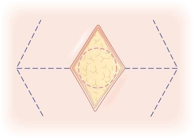 Transposition Flaps - Clinical Tree