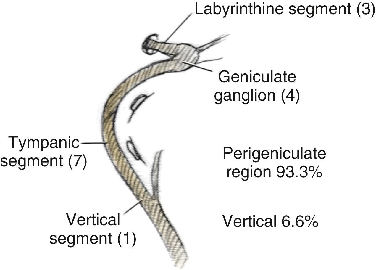 Traumatic Facial Paralysis - Clinical Tree