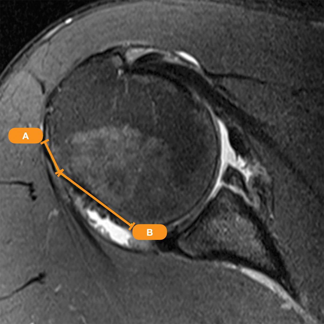 Treatment Of Combined Bone Defects Of The Humeral Head And Glenoid
