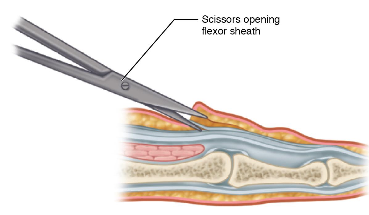 Trigger finger release: Open and percutaneous - Clinical Tree