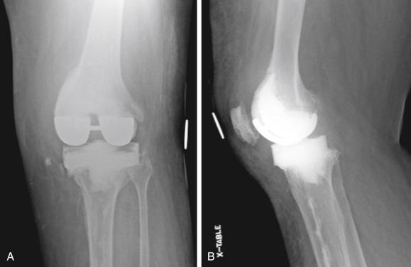 Two-Stage Revision - Clinical Tree