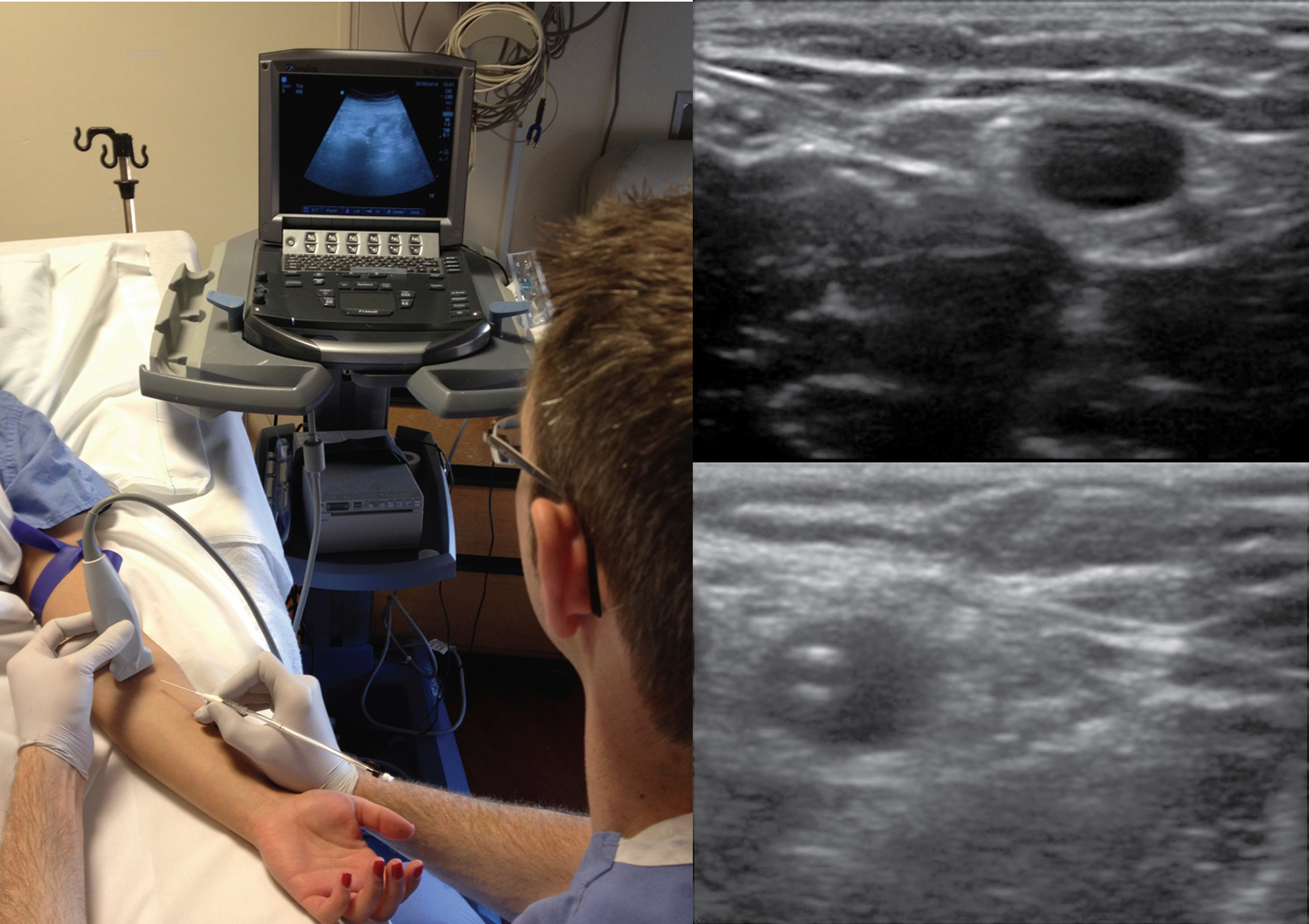 Ultrasound-guided peripheral intravenous access - Clinical Tree Ultrasound-guided peripheral intravenous access - Clinical Tree