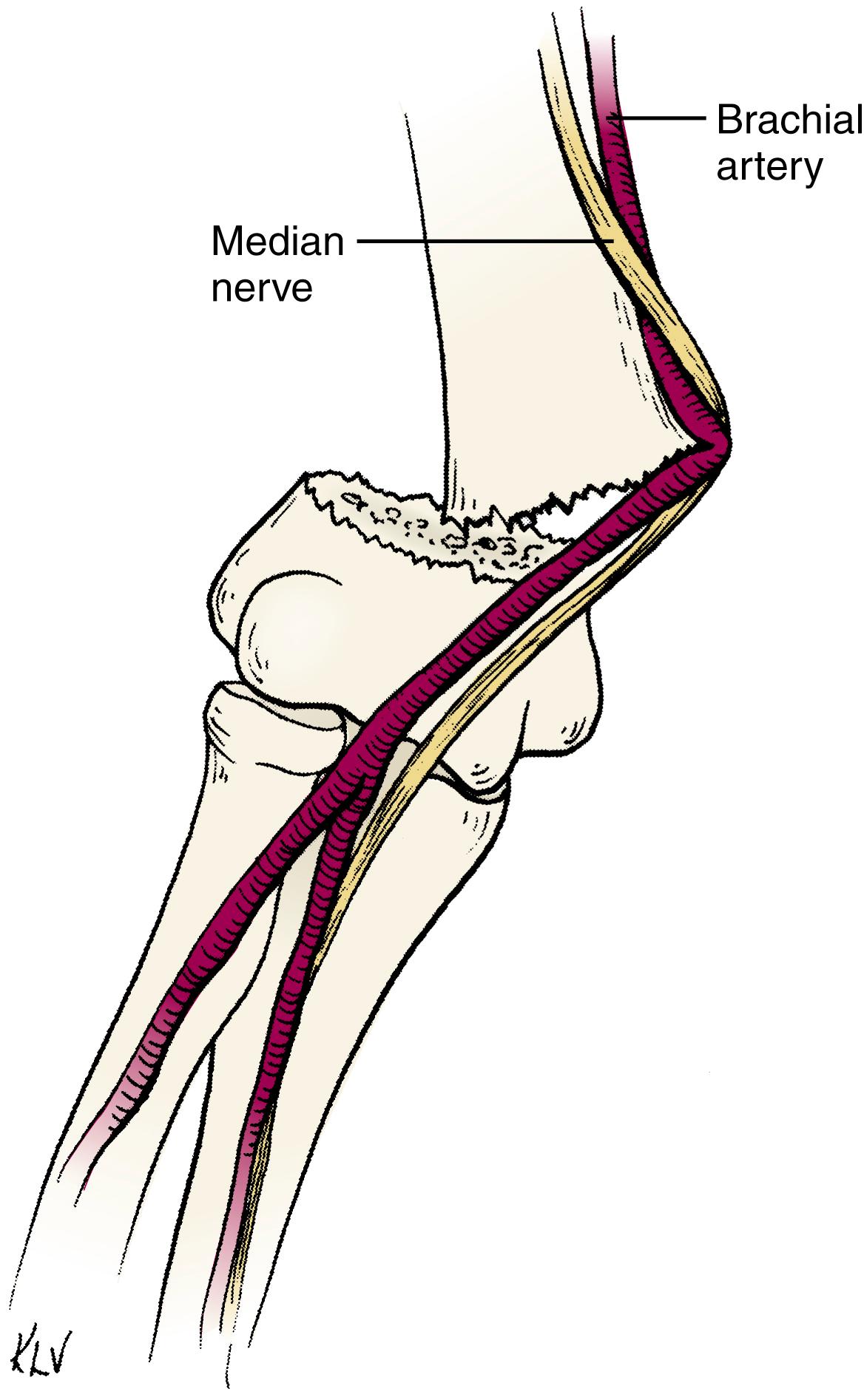 Upper Extremity Injuries - Clinical Tree