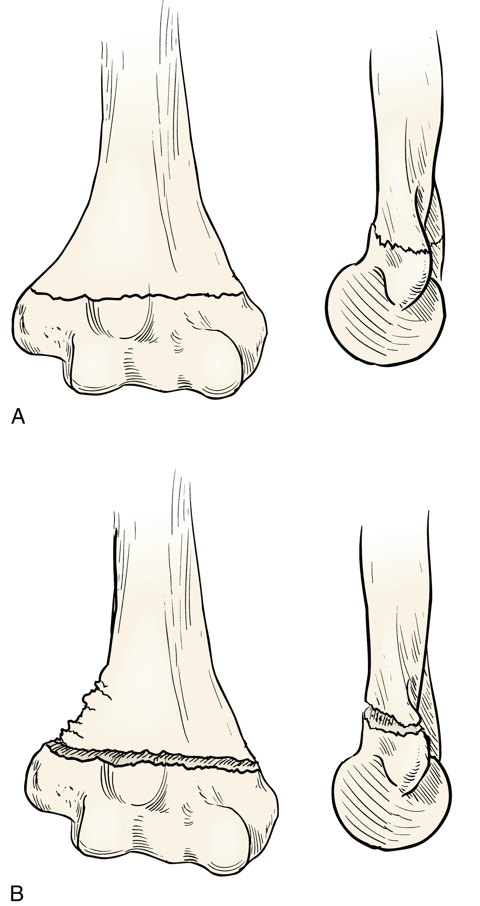 Upper Extremity Injuries - Clinical Tree