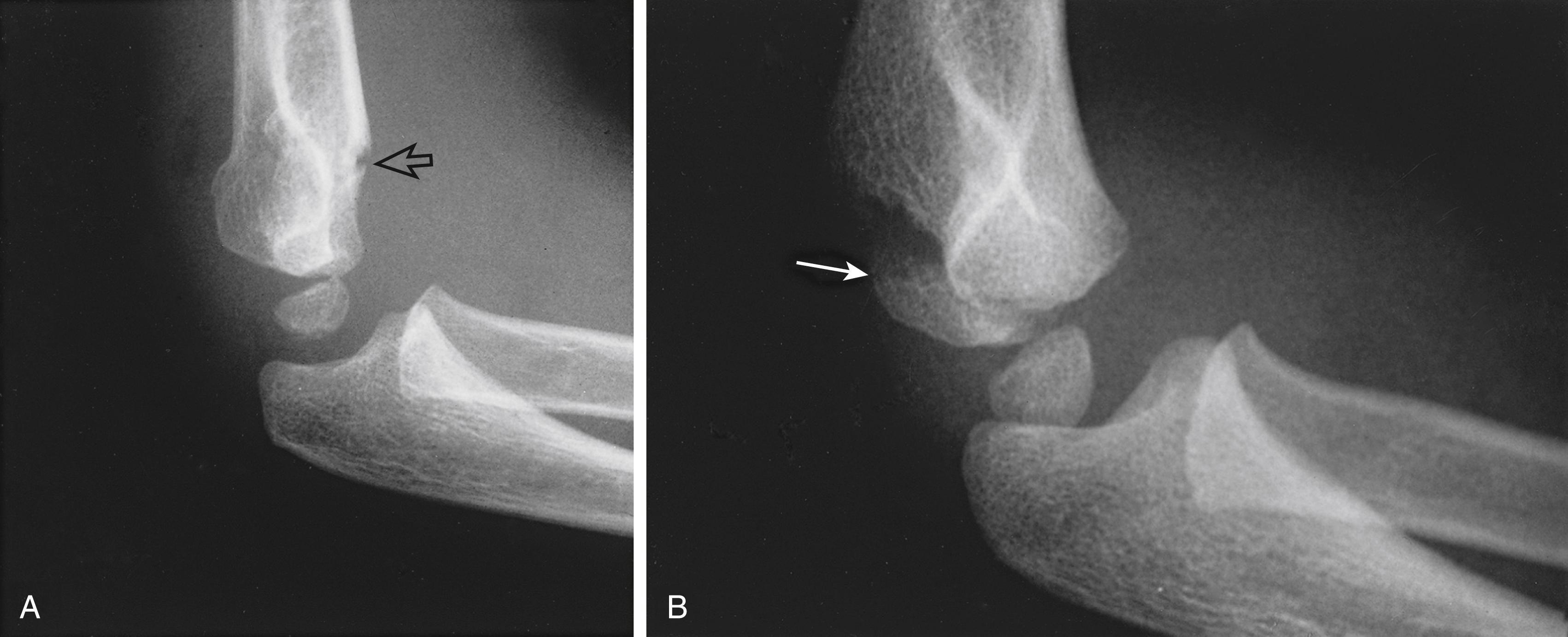 Upper Extremity Injuries - Clinical Tree