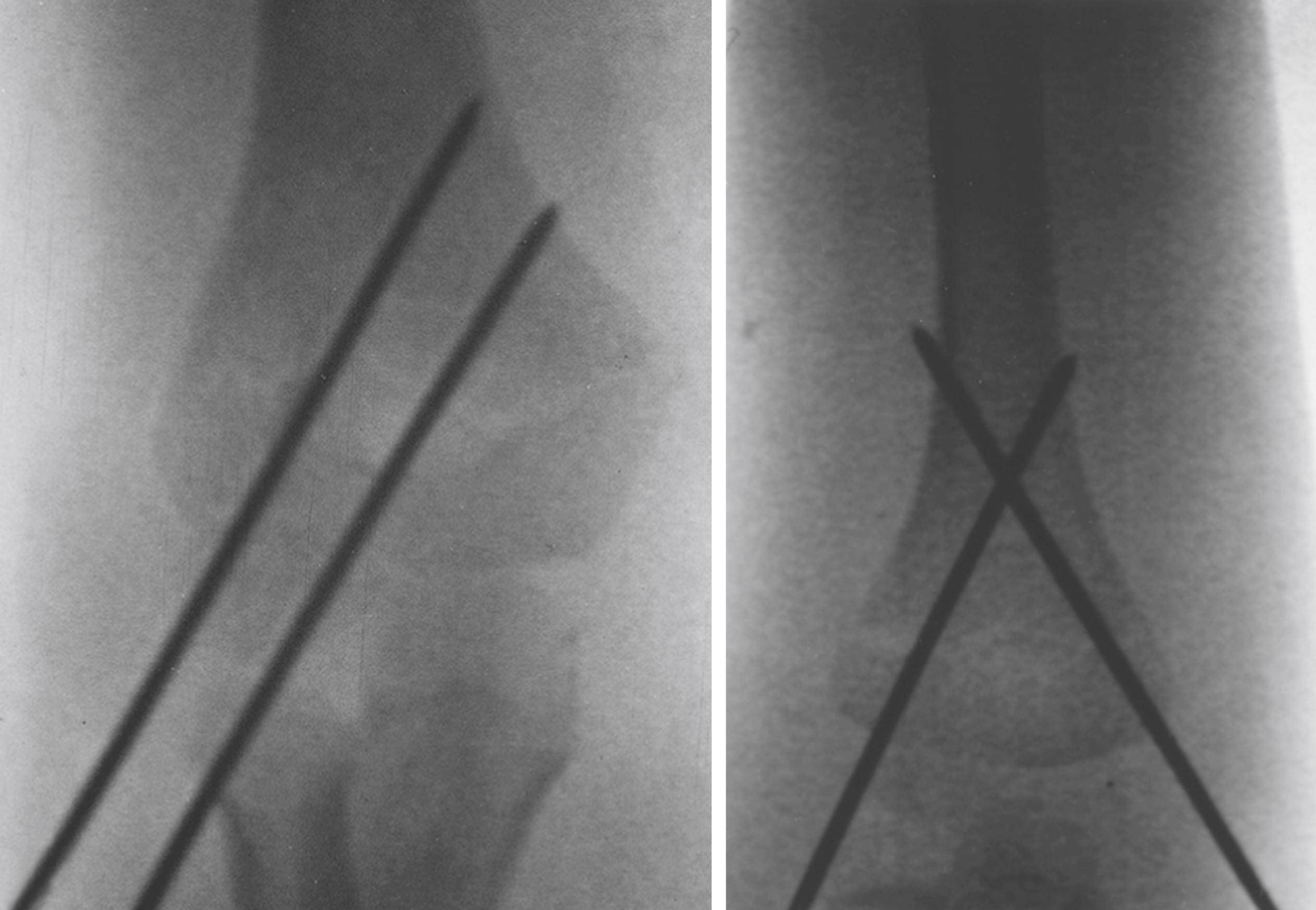 Upper Extremity Injuries - Clinical Tree