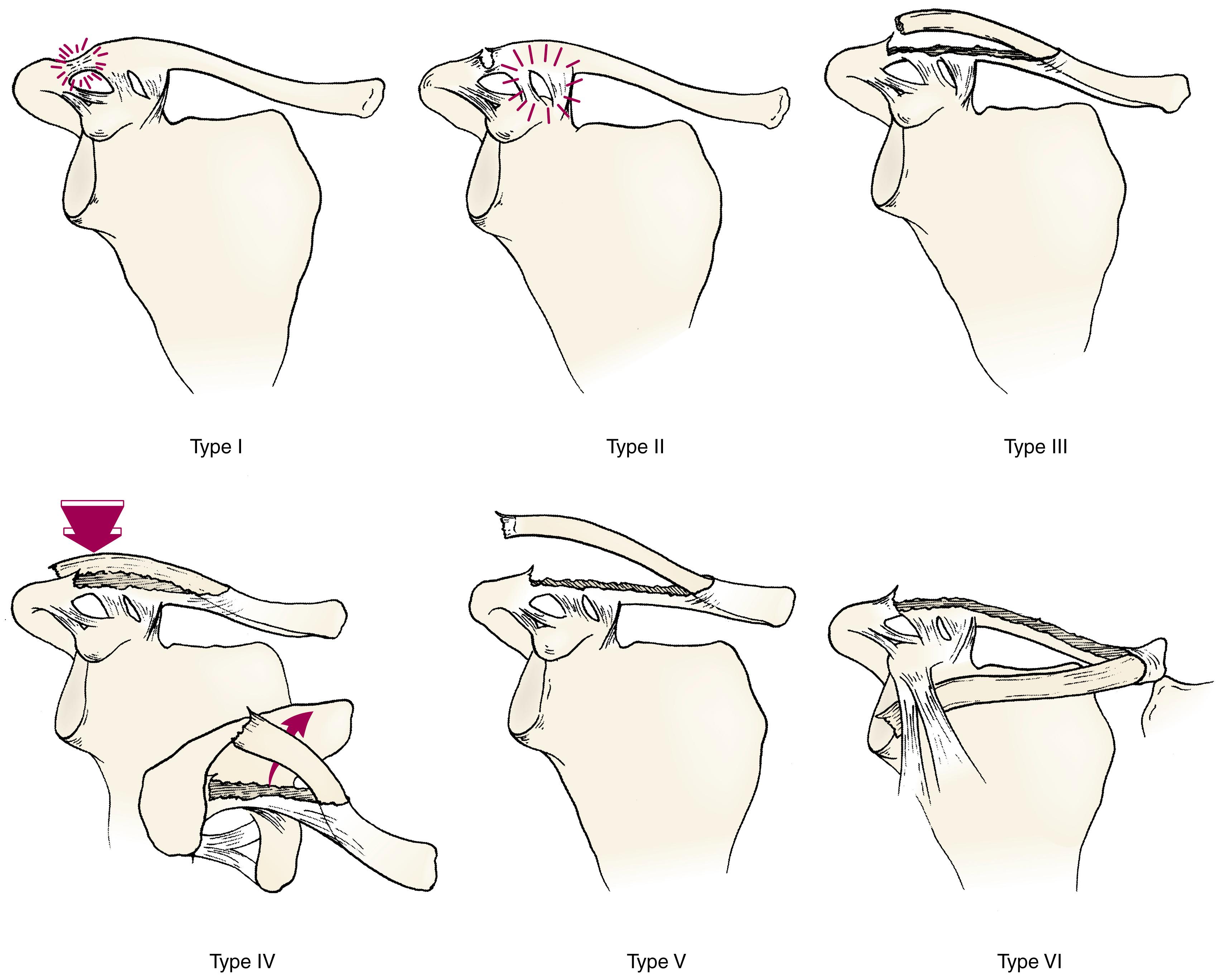 Upper Extremity Injuries - Clinical Tree