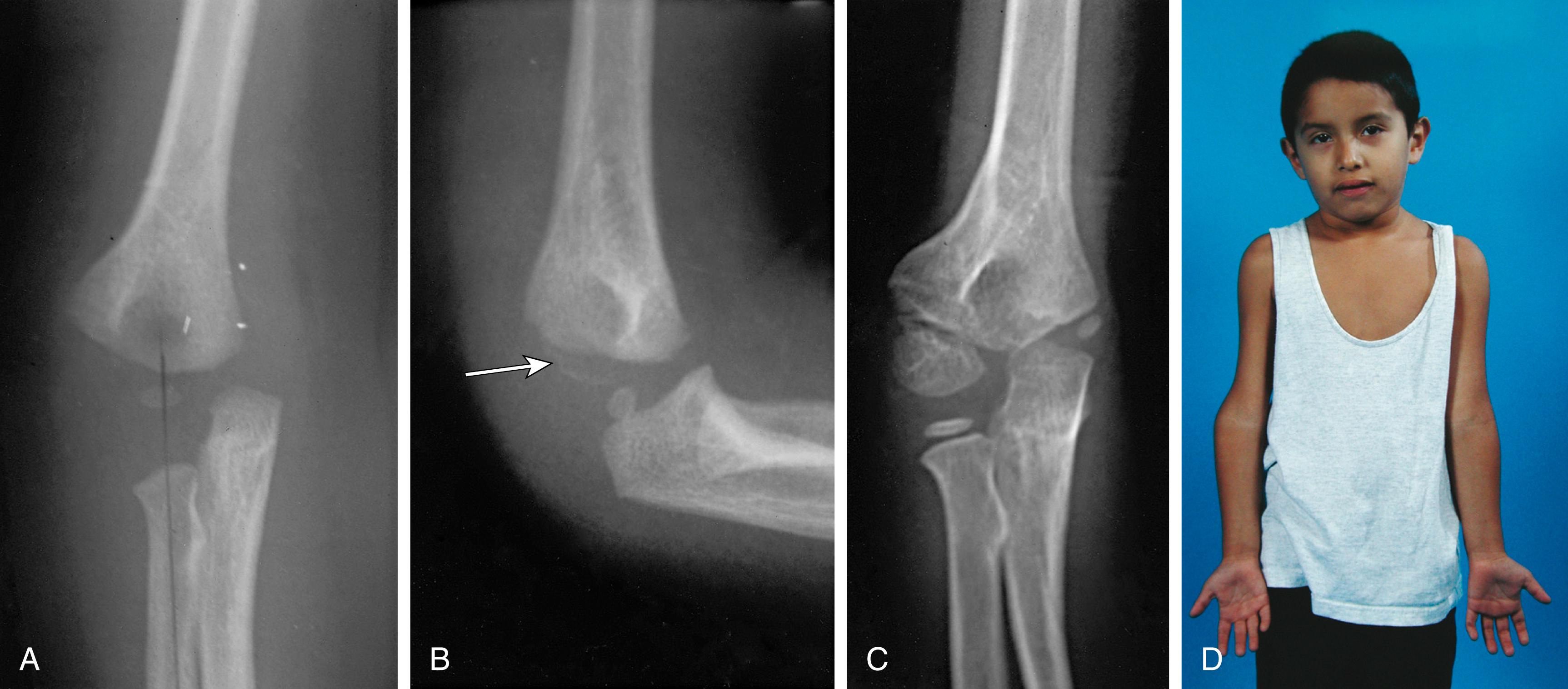 Upper Extremity Injuries - Clinical Tree