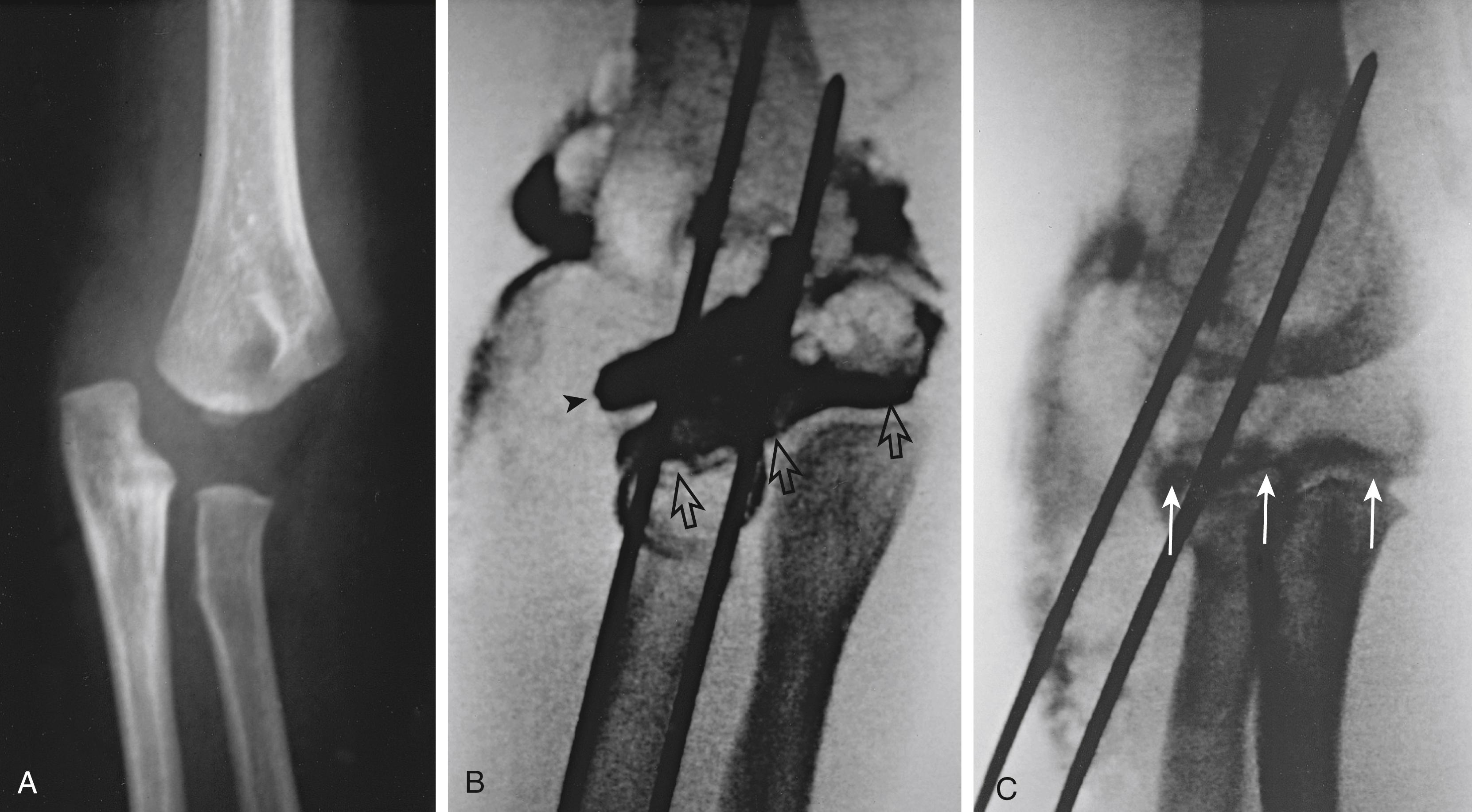 Upper Extremity Injuries - Clinical Tree