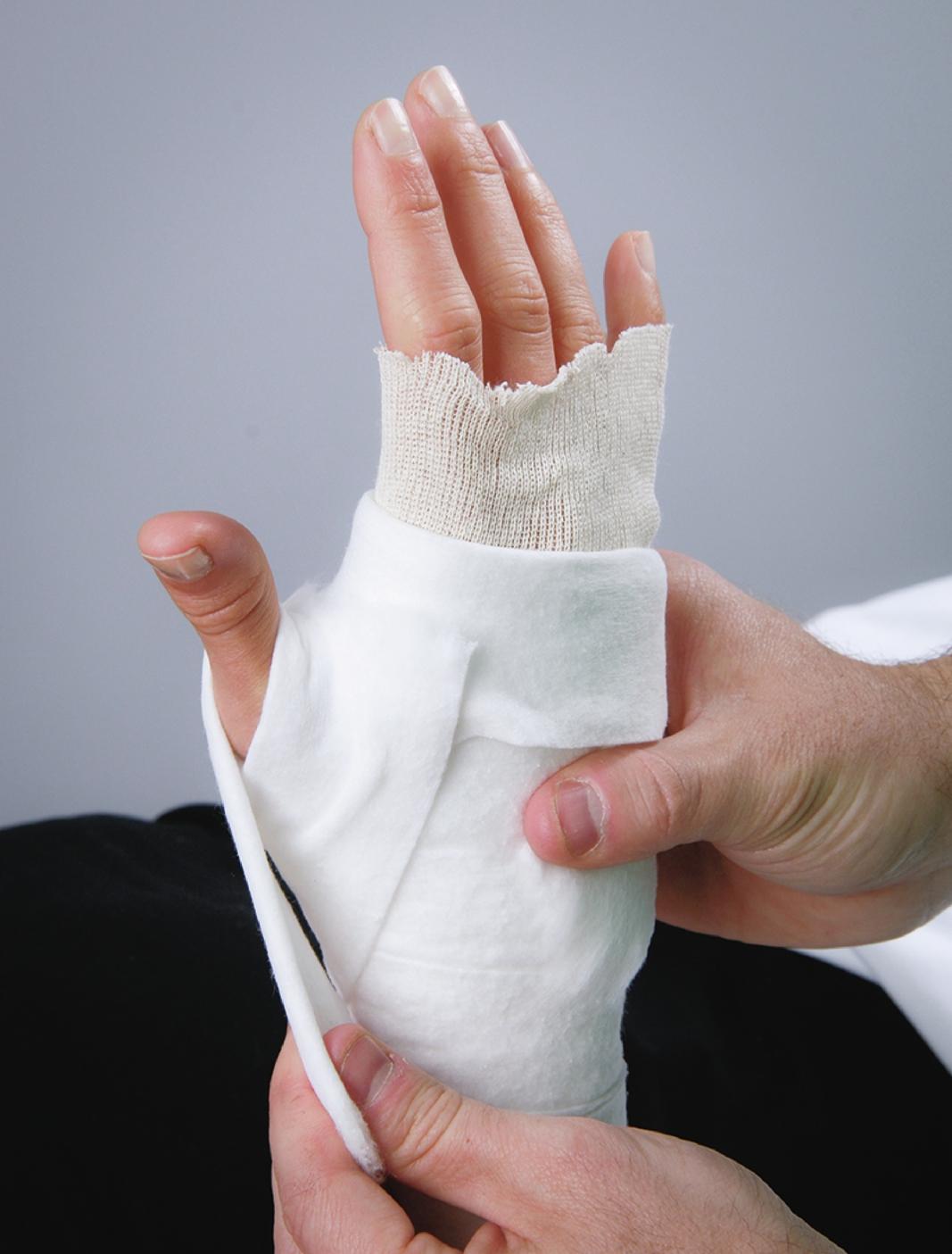 Upper Extremity Splints and Casts - Clinical Tree