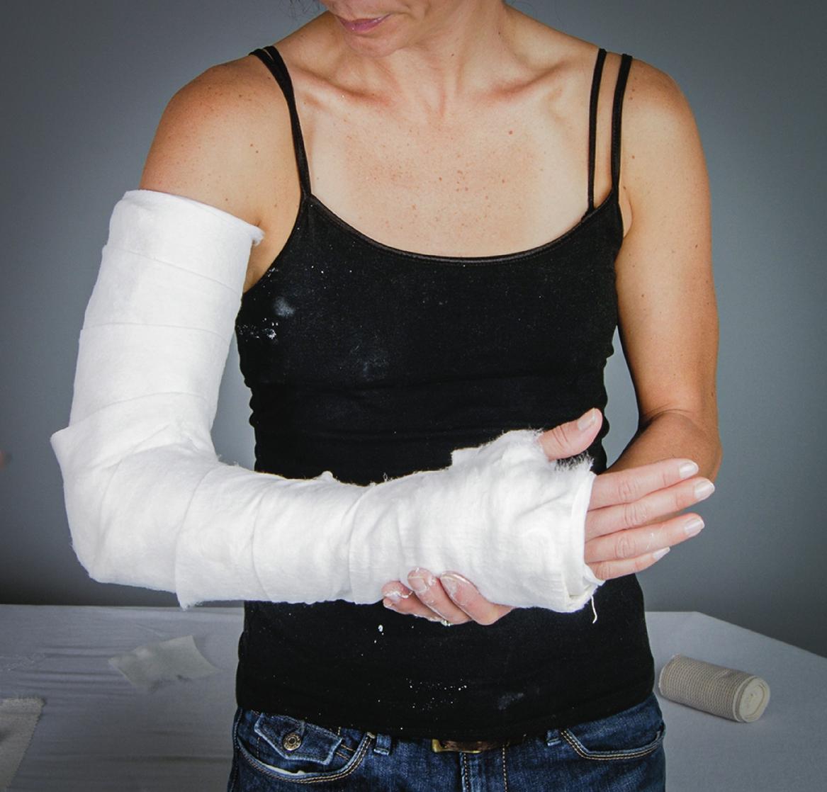 Upper Extremity Splints and Casts - Clinical Tree