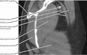 Upper Limb - Clinical Tree