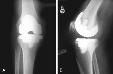 Use of Constrained Implants - Clinical Tree