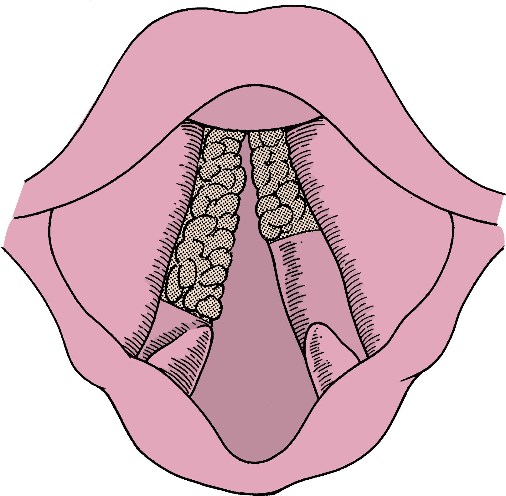 Vertical Partial Laryngectomy - Clinical Tree Vertical Partial Laryngectomy - Clinical Tree