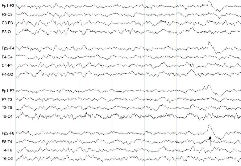 Visual Analysis of the EEG:: Wakefulness, Drowsiness, and Sleep ...
