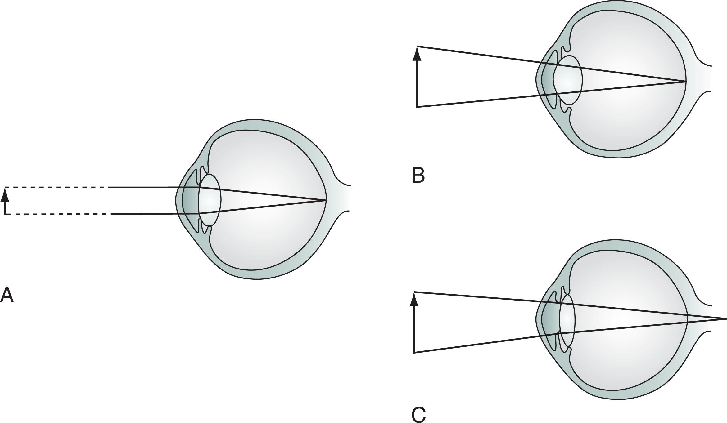 Visual Disturbances - Clinical Tree