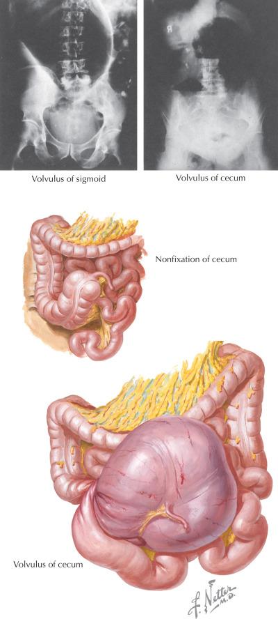Volvulus, Sigmoid, and Cecum - Clinical Tree