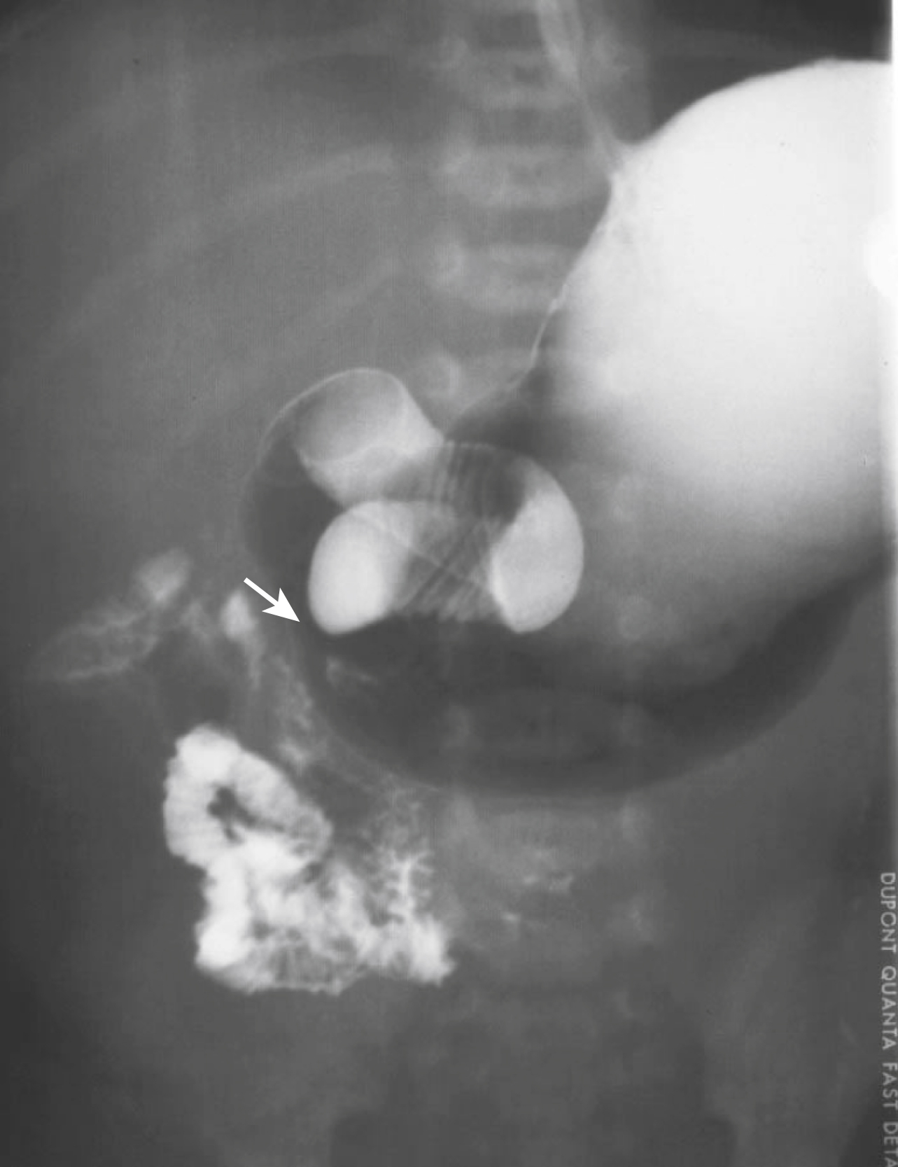 Vomiting Infant - Clinical Tree