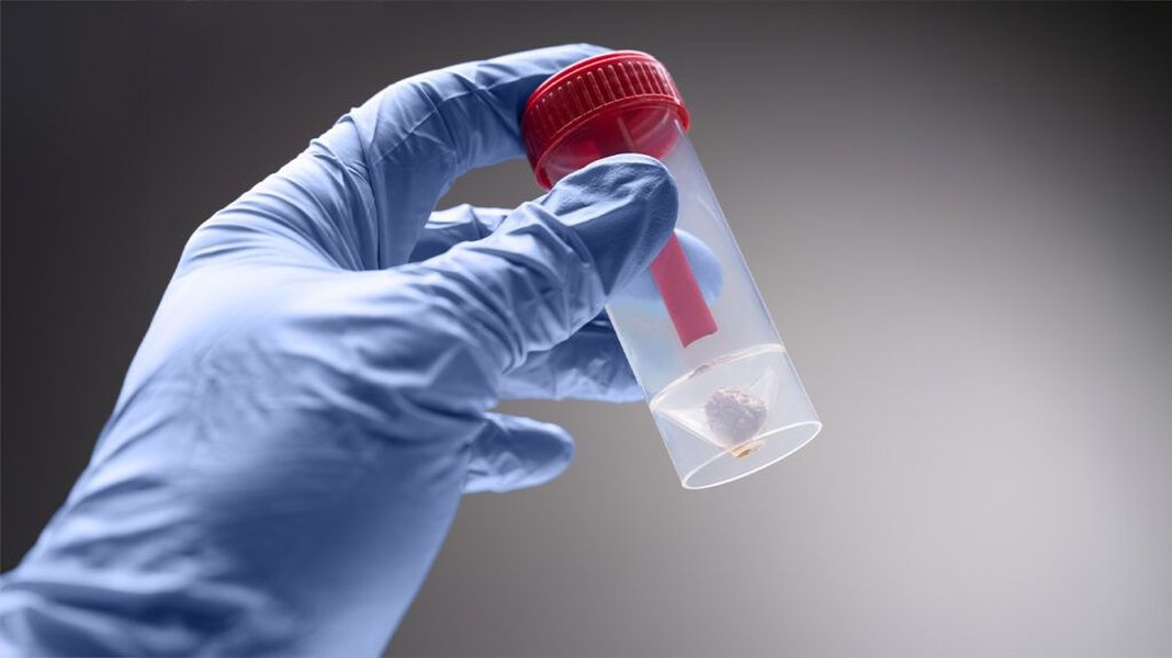 Ithy - Unlocking Gut Health: A Deep Dive into the Calprotectin Stool Test