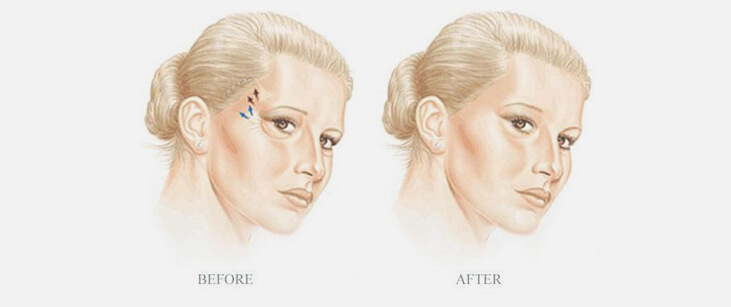 Ithy - Lifting Temporal : Rajeunissement Esthétique de Précision
