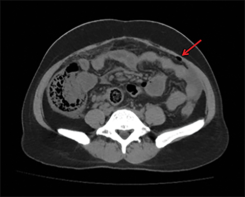Ithy - Differentiating between Intestinal Tuberculosis (ITB) and Crohn ...