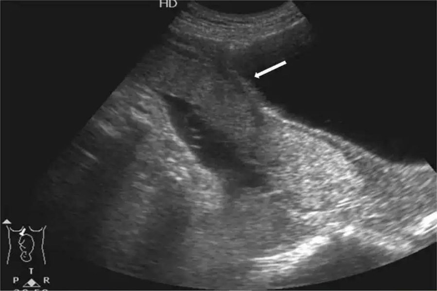 Ithy - Placenta Multilobulada: Una Variación Anatómica Inusual del Embarazo