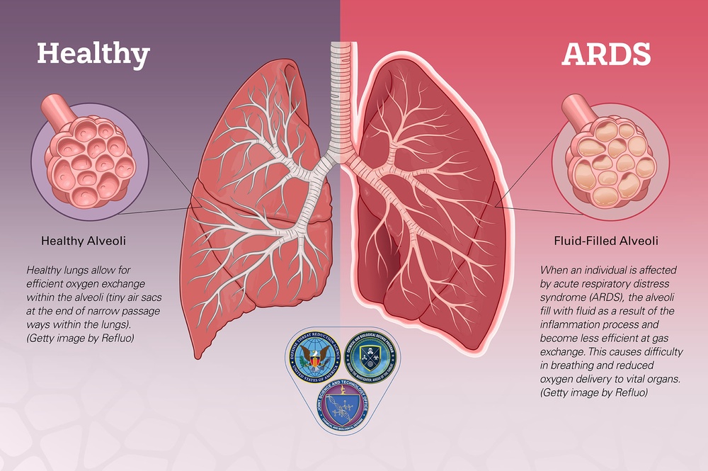Ithy - High Oxygen Saturation and Lung Tissue Damage After Bleomycin