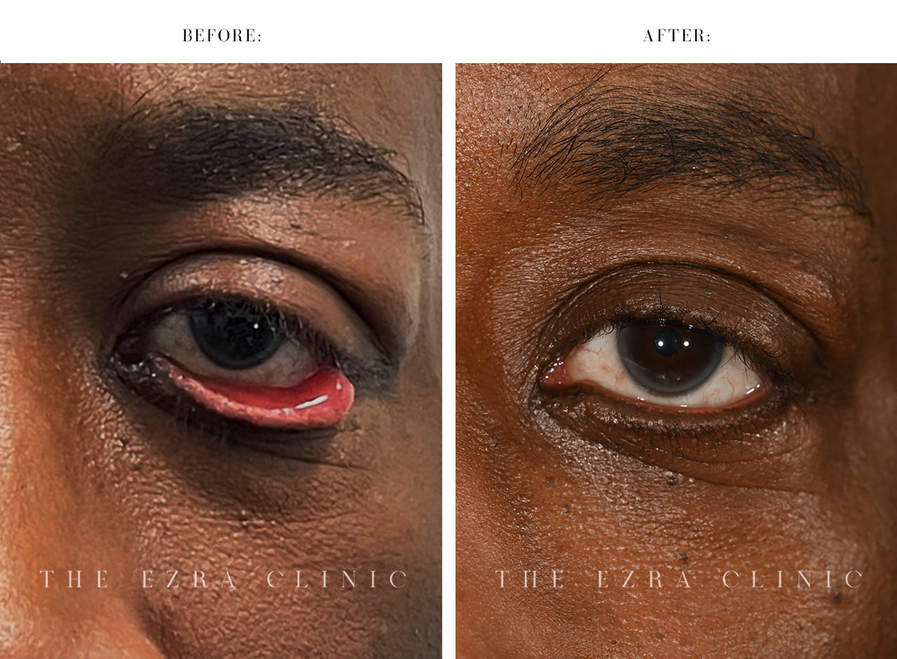 Ithy - Nocturnal Lagophthalmos: Diagnosis and Treatment