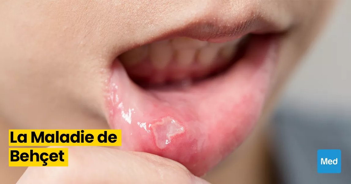 Ithy - La Maladie de Behçet : Décryptage Complet d'une Affection ...