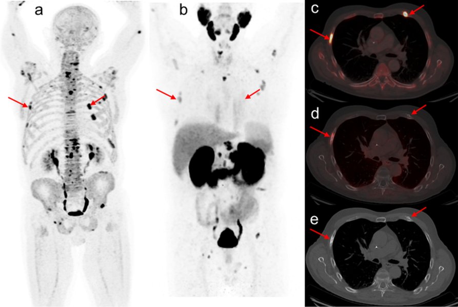 Ithy - Unraveling the Puzzle: How a Single Bone Metastasis Can Emerge ...