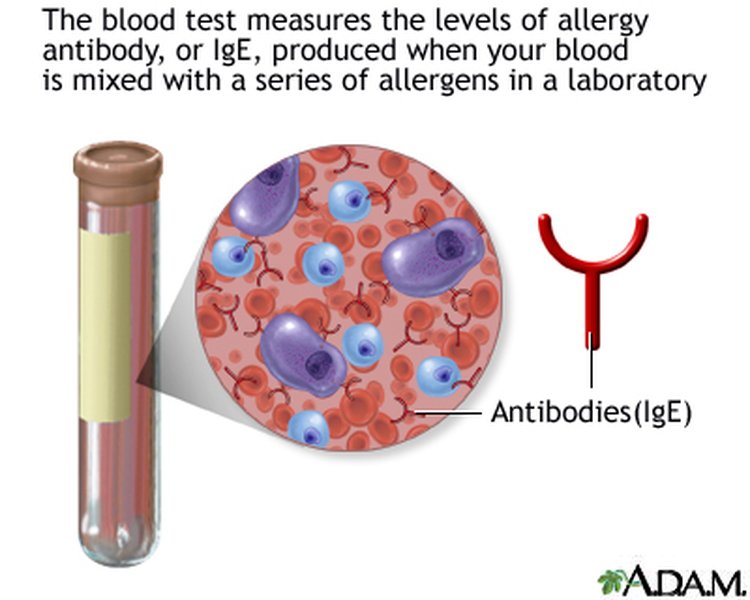 Ithy - Unlocking the Secrets of Total Immunoglobulin E: Your Body's ...