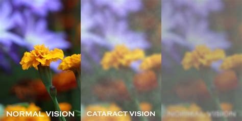 Ithy - Understanding Cataracts: Causes and Prevention