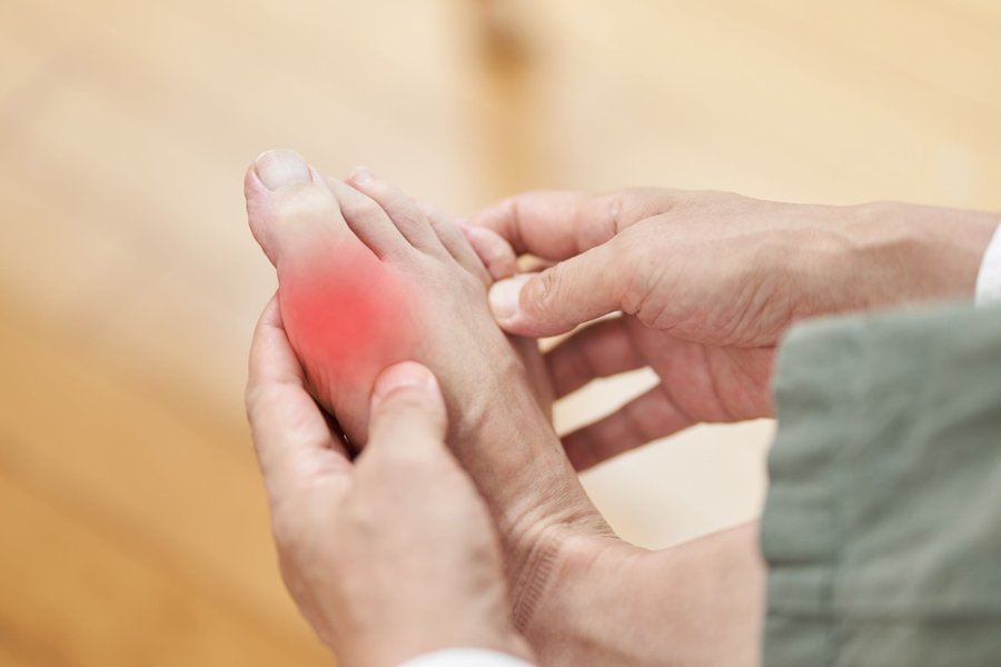 Ithy - Understanding Hyperuricemia: Causes, Symptoms, and Management