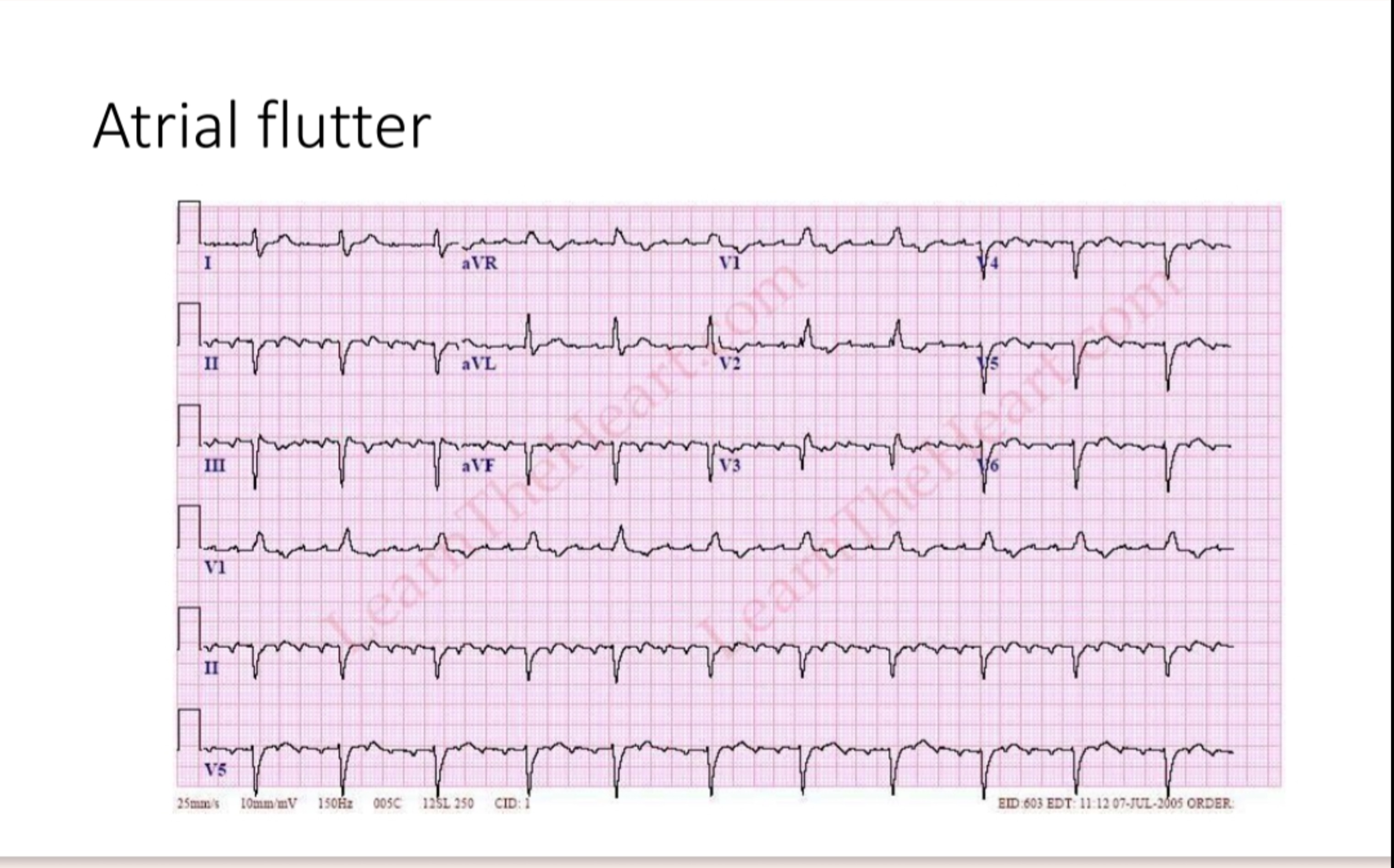 What is atrial flutter? Identify its ECG features and explain its ECG dia..