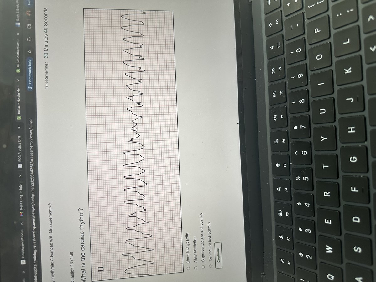 What is the cardiac rhythm? Options: Sinus tachycardia Atrial fibrillati..