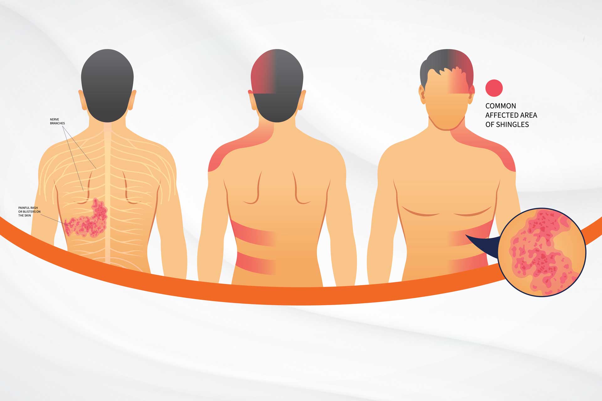 ‘งูสวัด สกัดได้ Stop Shingles - Gen ยัง Active 50+