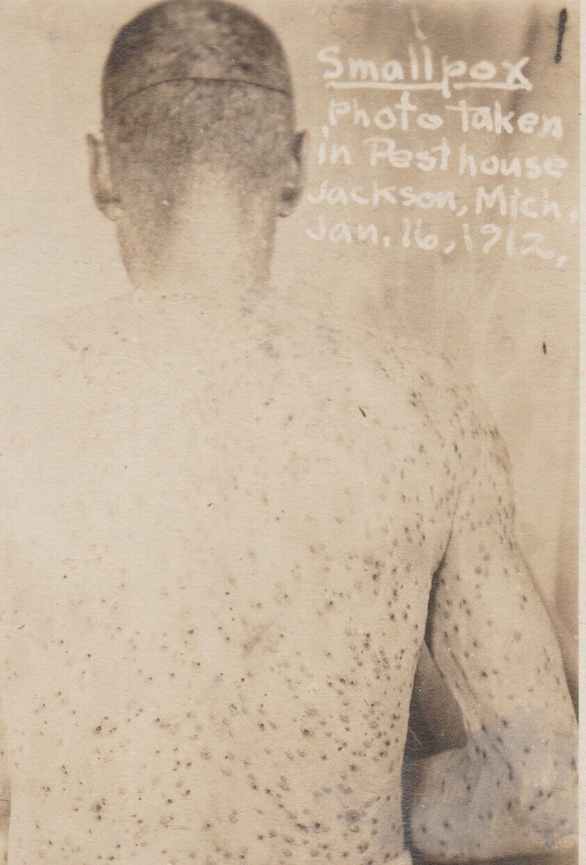 Jackson MI RPPC 1912 SMALLPOX PATIENT Disease Pest House SOCIAL HISTORY ...