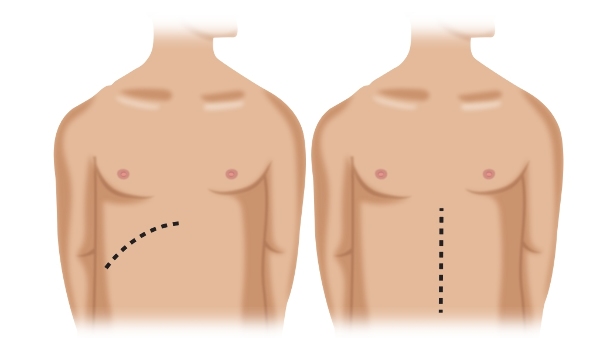 Open Adrenalectomy