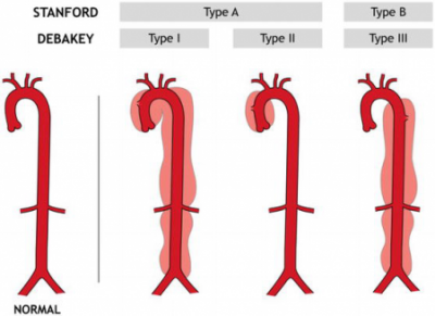 Dissecção de aorta: tudo que você precisa saber - Medway