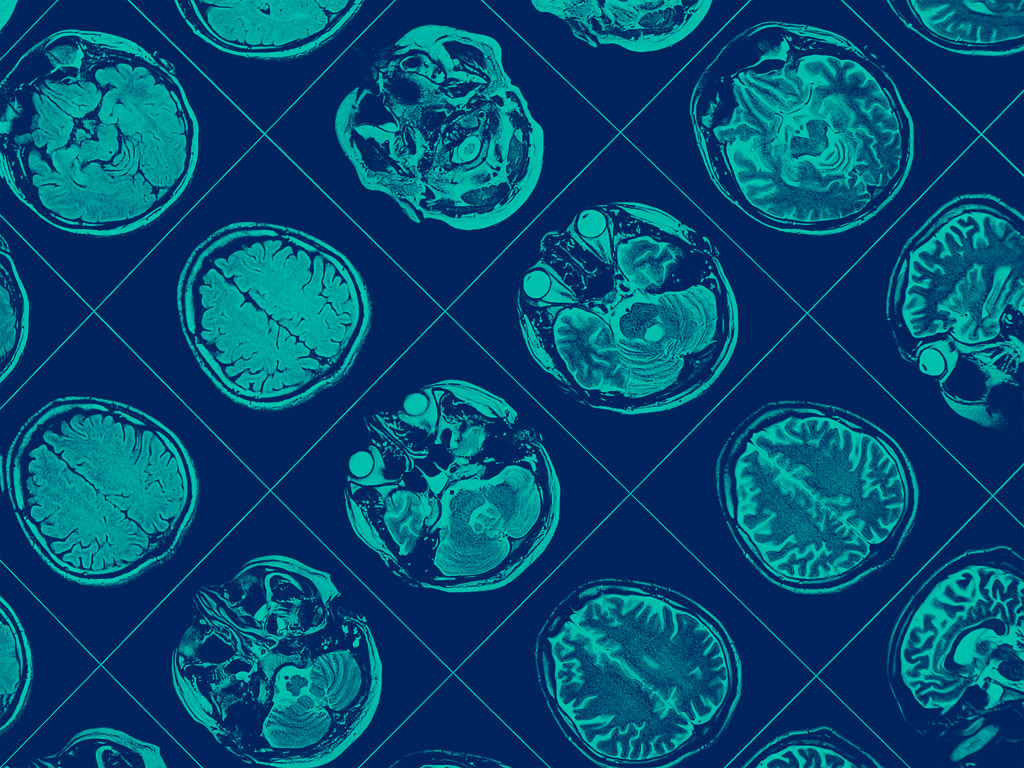 Escala de Marshall: classificando o traumatismo craniano encefálico ...