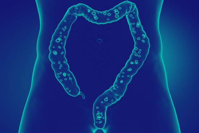 Entendendo as causas da diverticulite - Medway