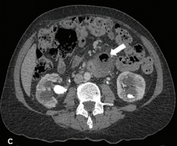Diverticulite de Meckel: o que é e como diferenciar - Medway