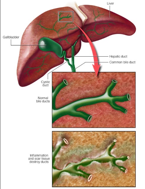Colangite: tudo que você precisa saber para tratar um paciente - Medway