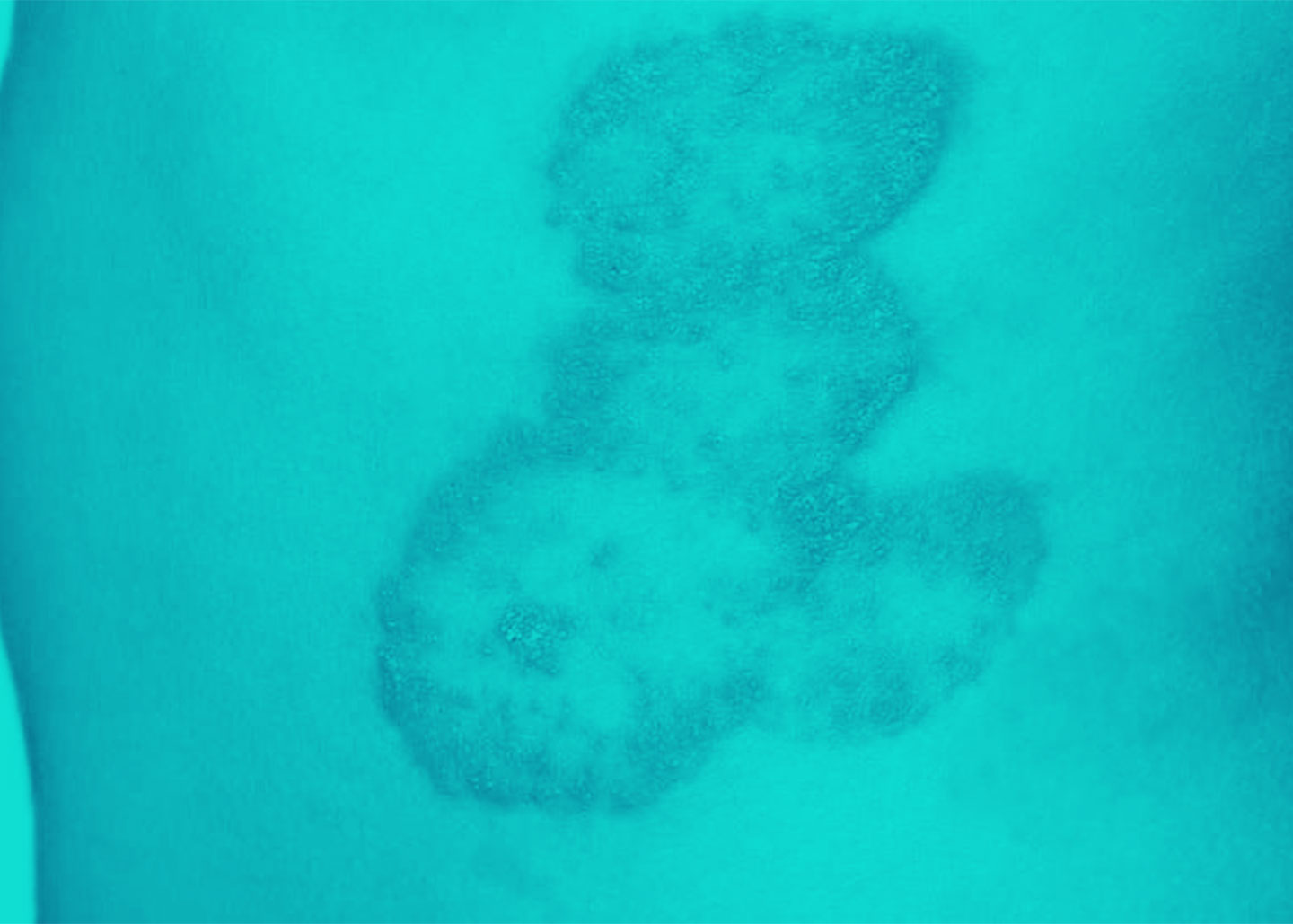 Dermatofitose: micoses da cabeça aos pés! - Medway