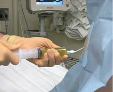 Toracocentese: tudo que você precisa saber - Medway