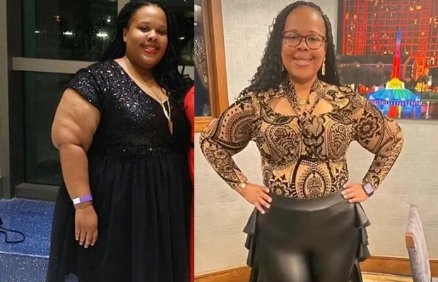 A New Beginning: How Bariatric Surgery Transformed Jessica Causey’s ...