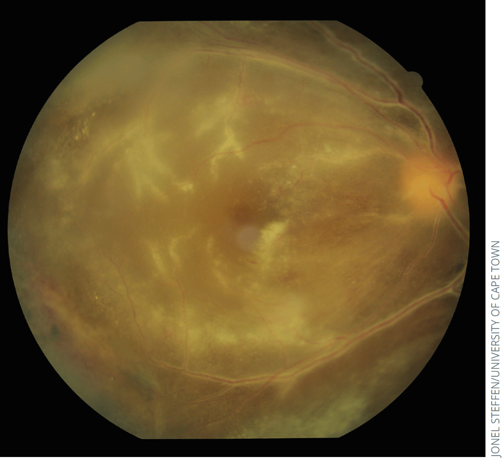 Cytomegalovirus: clinical features and management | Community Eye ...