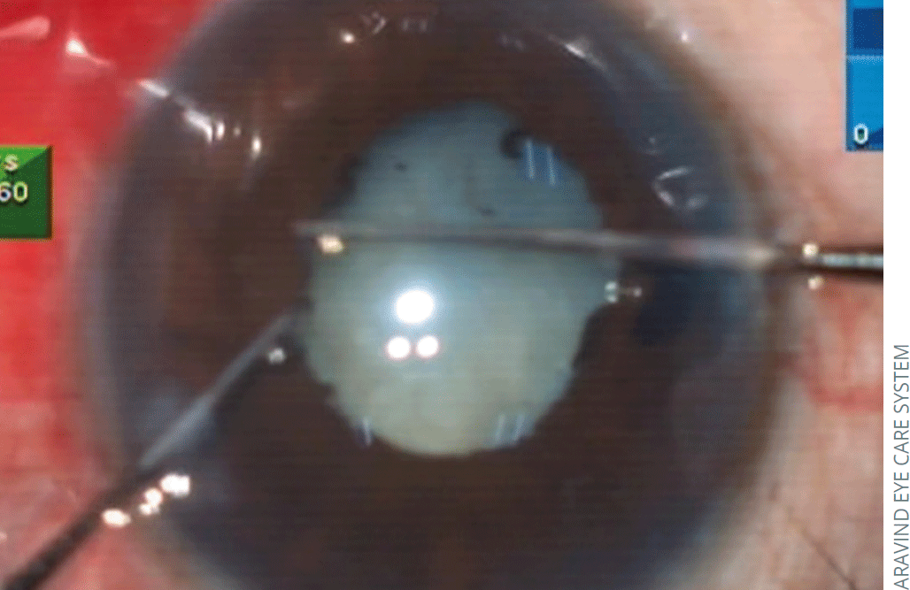 Managing cataract surgery in patients with uveitis | Community Eye ...