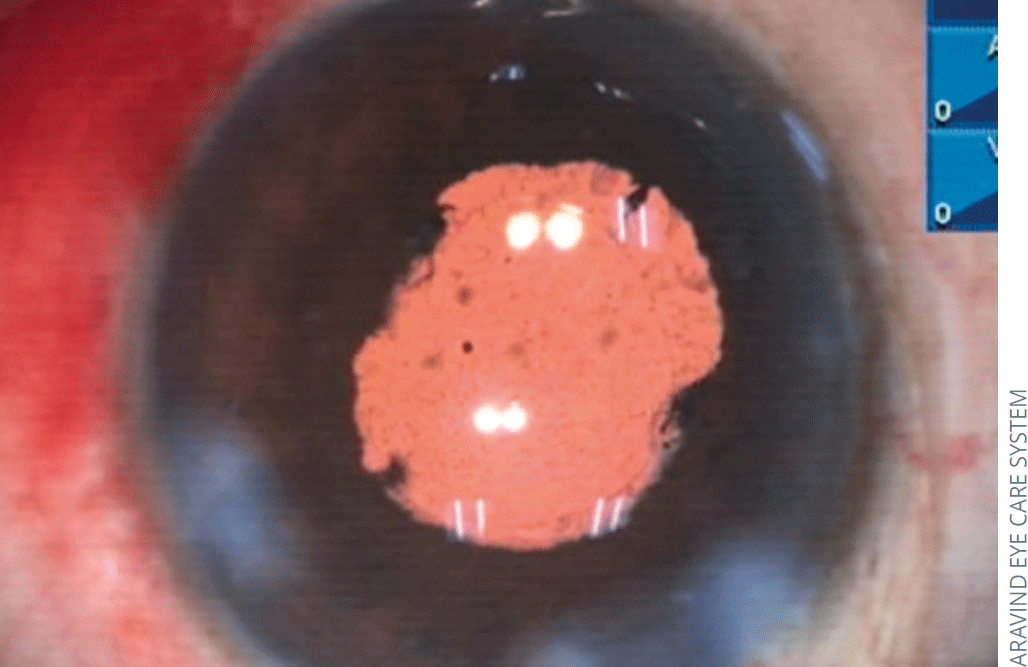 Managing cataract surgery in patients with uveitis | Community Eye ...